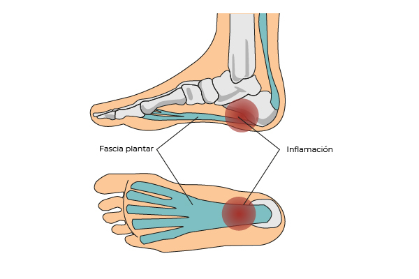Fascitis Plantar | Viamed Salud
