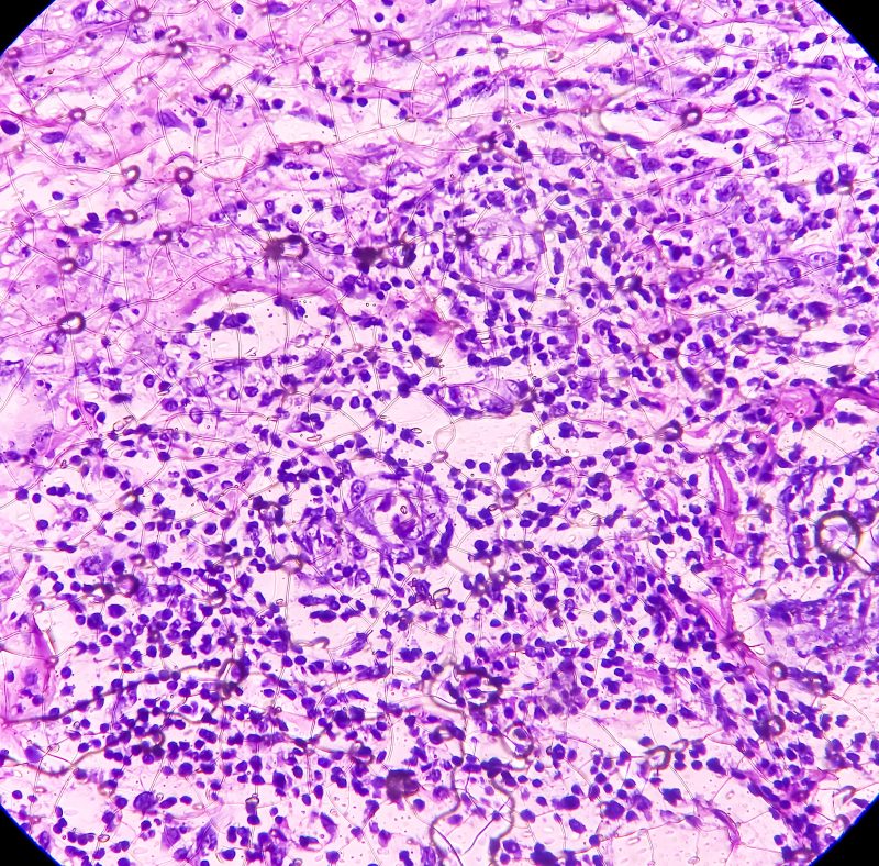 quistes | Viamed Salud